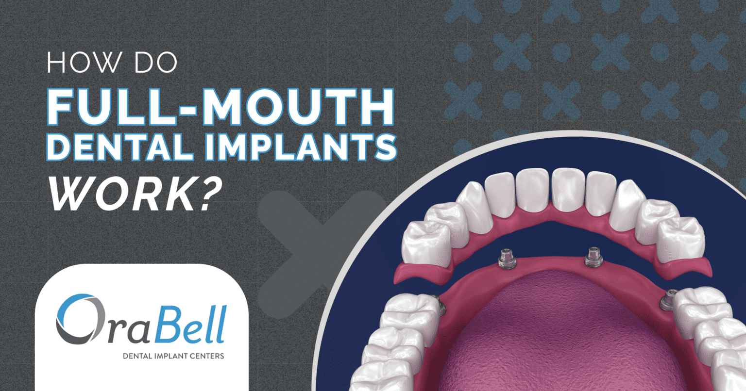 How Do Full-Mouth Dental Implants Work? | OraBell
